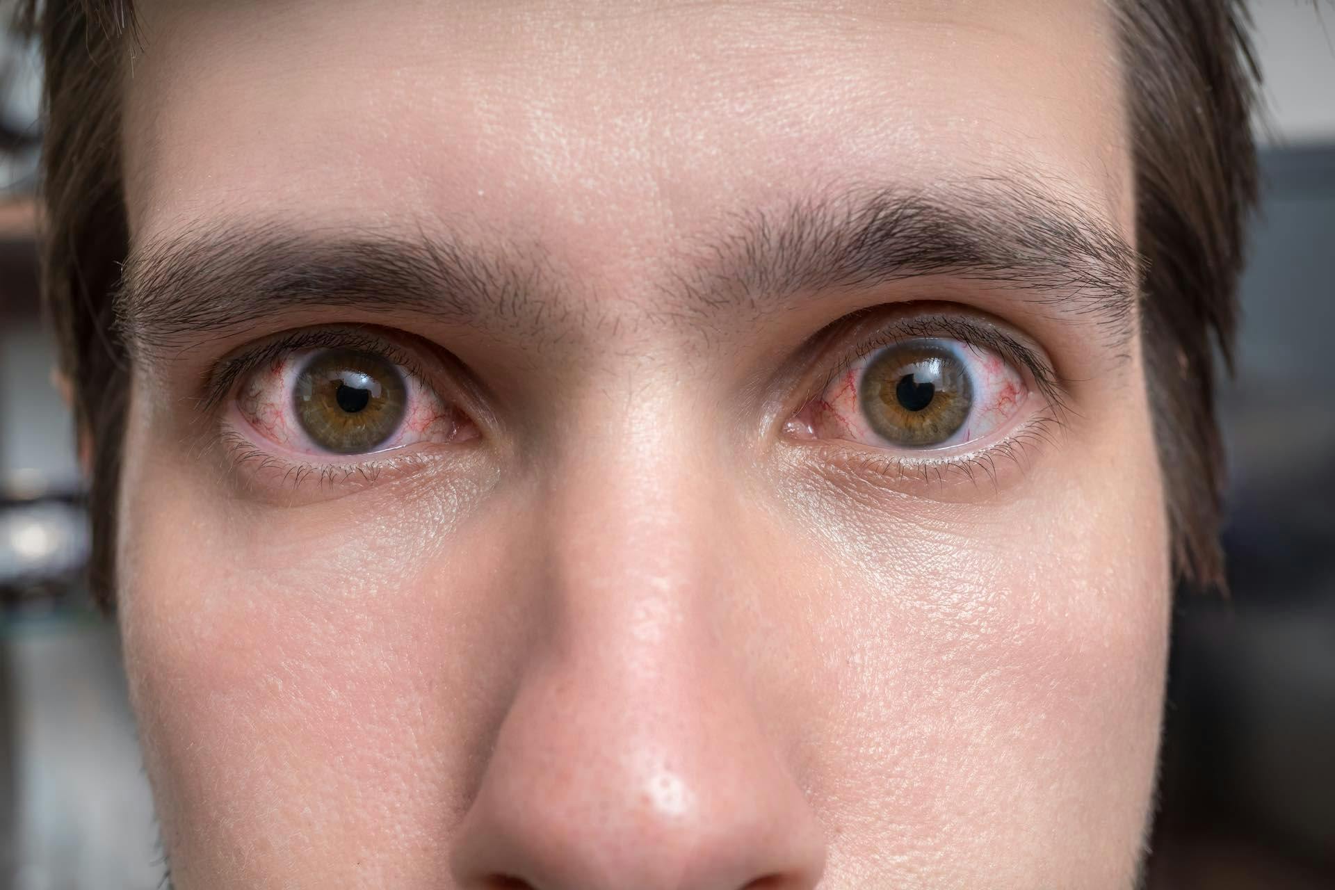 Why Smoking Cannabis Causes Red, Bloodshot Eyes | Leafly