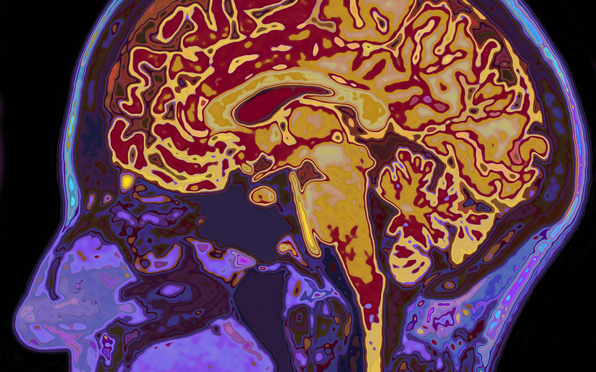 Cannabis & Its Effects on Brain Damage After Injury | Leafly